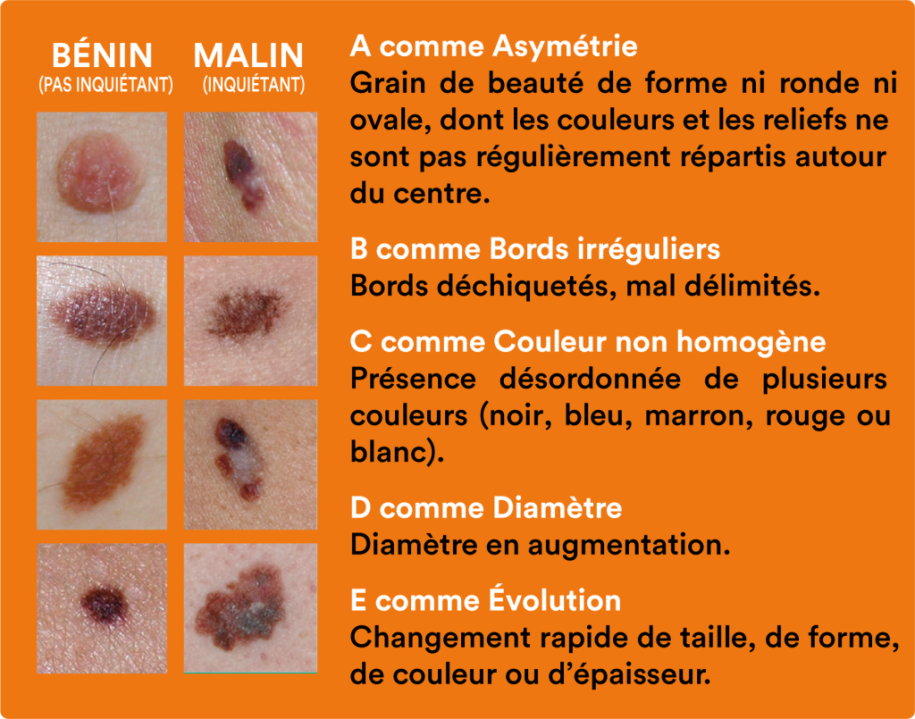 Cancers de la peau - ICPF